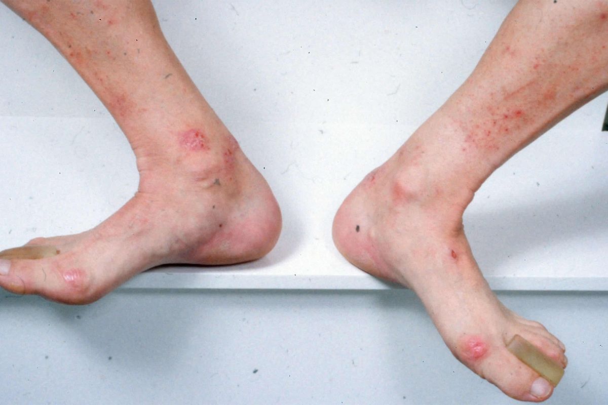 The Agony of Severe Atopic Dermatitis - Its The Vibe
