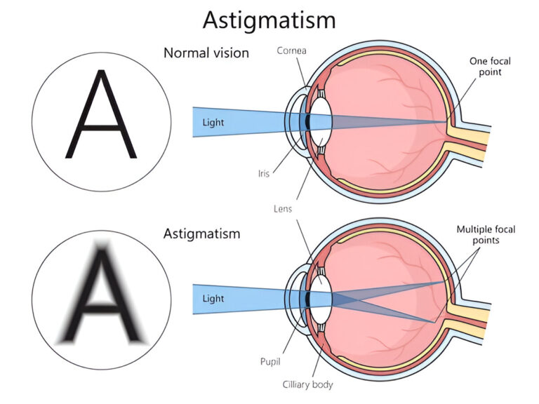 Does Astigmatism Go Away? Know Changes in Your Vision